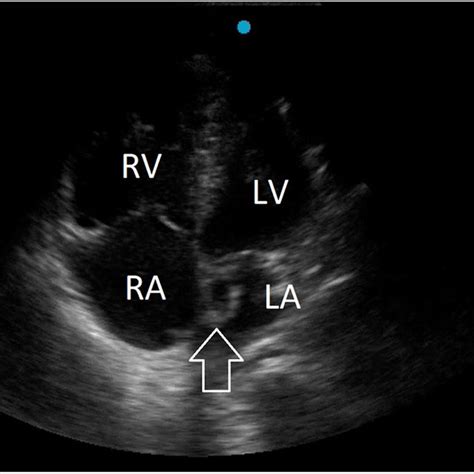 Still Image Of The Patients Plethoric Ivc The Ivc Was 21cm In