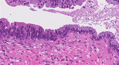 Adenocarcinoma In Situ Of The Cervix Ottawa Atlas Of Pathology