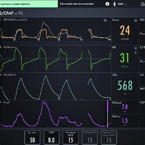 Ineffective Effort During Pressure Support Ventilation Download