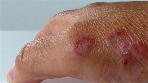 Identifying Different Types Of Eczema And How To Treat Them