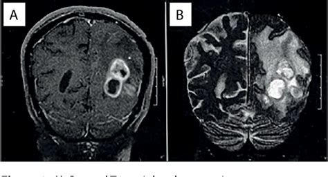 Figure 1 From Cryptococcoma Mimicking A Brain Tumor In An Figure 1 From Cryptococcoma Mimicking A Brain Tumor In An