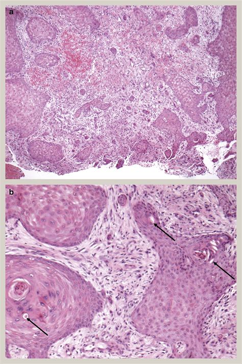 Pyoderma Gangrenosum And Pseudoepitheliomatous Hyperplasia A Poorly