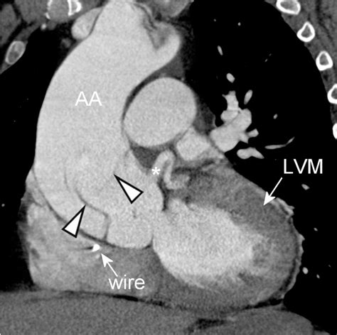 Figure From Aortic Dissection With Sheared Off Intimal Flap Semantic Scholar