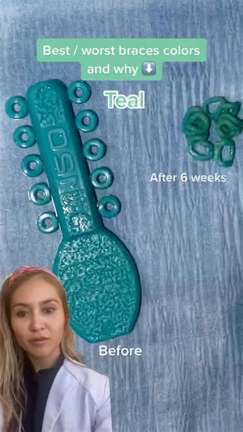 Best Braces Colors Teal Before And After Braces Braceson Bracescolors Artofit