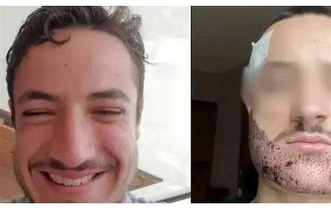 خودکشی بخاطر بد شدن کاشت ریش این پسر فرانسوی تا استانبول برای کاشت ریش