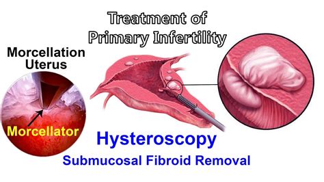 Hysteroscopy Fibroid