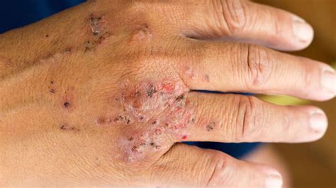 Top Ten Common Skin Spots Advanced Dermatology Of The Midlands
