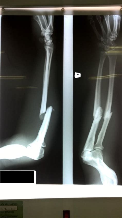 Classification Of Radius Ulna Fracture At Kaitlyn Nuyts Blog