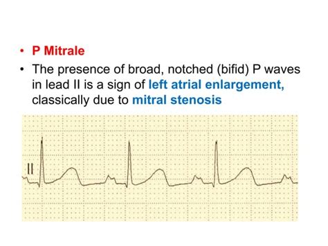 P Wave In Ecgabnormalities Of P Wave In Ecg Pptx Heart And Cardiovascular Diseases