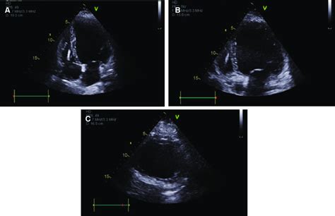 Transthoracic Echocardiogram Following Treatment With Anticoagulation Download Scientific
