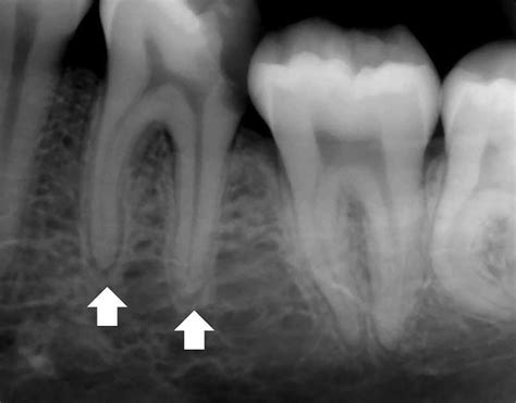 Differential Diagnosis Of Periapical Radiopacities And Radiolucencies