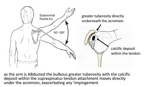 Shoulder Calcification Surgery Recovery Time