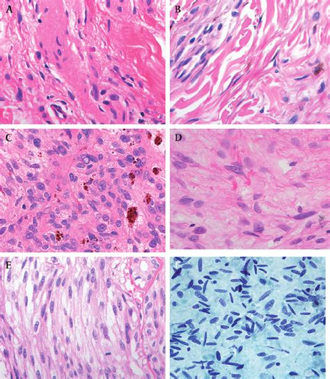 Spindle Cells Histology At Harold Walters Blog