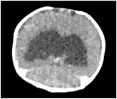 Axial Section Of Brain Ct Showing The Presence Of The Interhemispheric Download Scientific