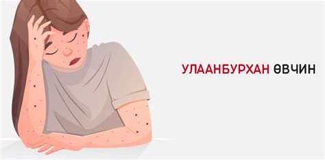 ХӨСҮТ Улаанбурхан өвчний лабораториор батлагдсан тохиолдол 1756 болжээ Tsoh Mn