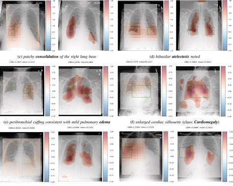 Figure 3 From Zero Shot Medical Phrase Grounding With Off The Shelf Diffusion Models Semantic