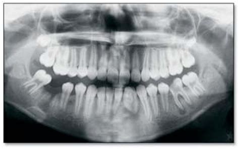 Figure 3 From Dens Invaginatus On A Geminated Tooth A Case Report