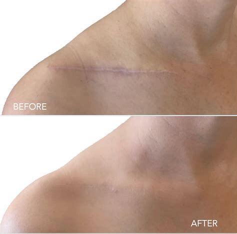 Makeup For Scars How To Conceal Like A Pro Dermaflage Store