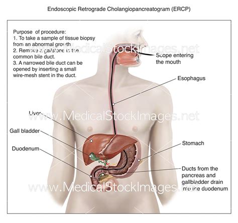 Endoscopic Retrograde Cholangiopancreatogram Labelled Medical Stock Endoscopic Retrograde Cholangiopancreatogram Labelled Medical Stock