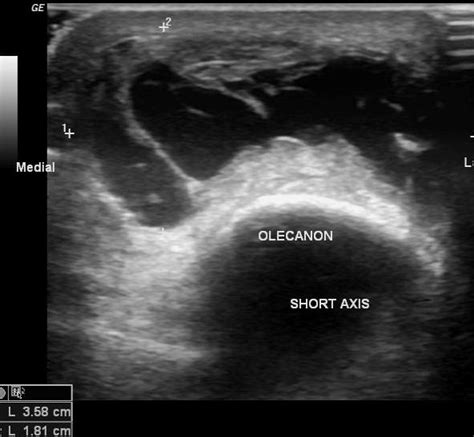 Olecranon Bursitis Causes Symptoms Treatment Olecranon