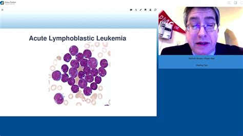 Acute Lymphoblastic Leukemia Chronic Myeloid Leukemia And The Myeloproliferative Neoplasms