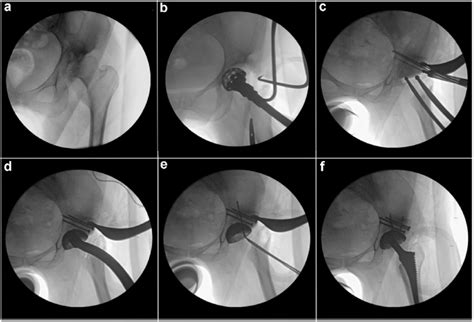 Intraoperative Fluoroscopy Depicting Surgical Technique A Download Scientific Diagram