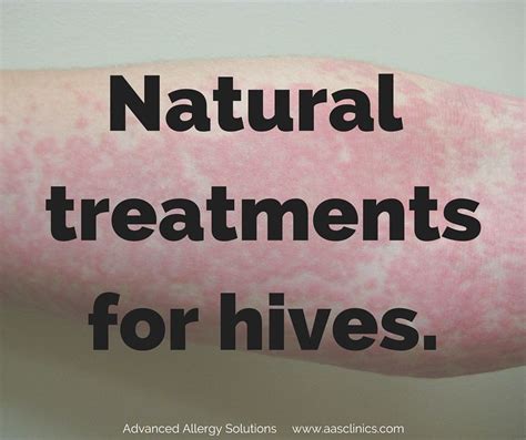 Do You Suffer From Hives In This Article We Discuss The Common Symptoms And Triggers For Hives