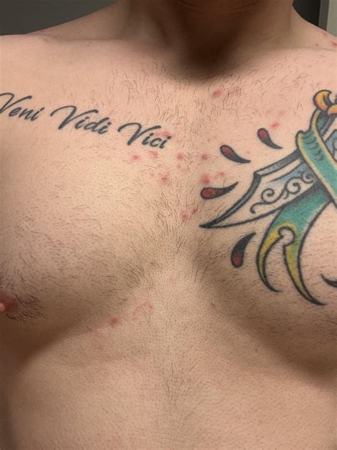 Is This Folliculitis Heat Rash Please Help Rfolliculitis