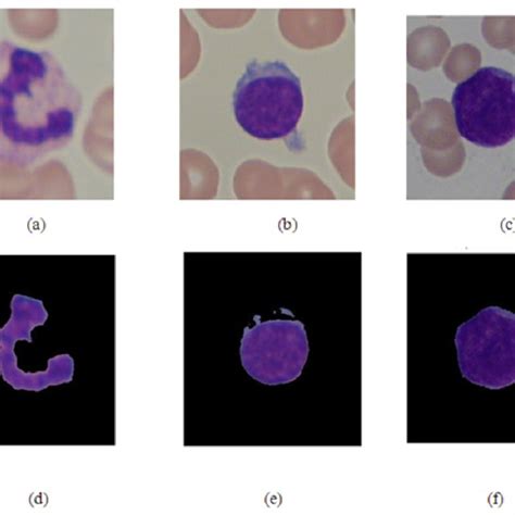 pdf k means clustering based segmentation of lymphocytic nuclei for acute lymphocytic leukemia