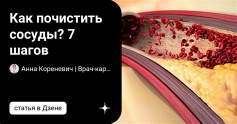 Как почистить сосуды 7 шагов Анна Кореневич Врач кардиолог Кардиопсихолог Дзен