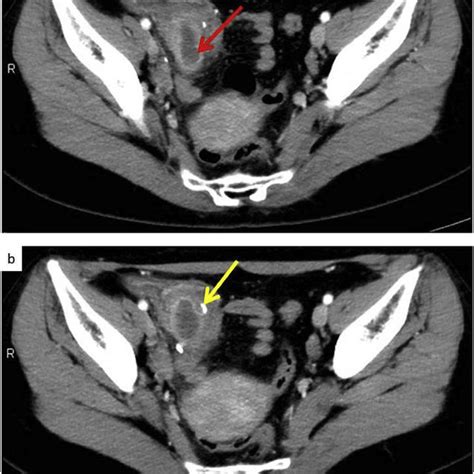 Ct Revealed An Abscess At The Right Lower Quadrant Download Scientific Diagram