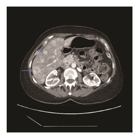 Computed Tomography Image Showing Multifocal Hepatic Lesions With Download Scientific Diagram