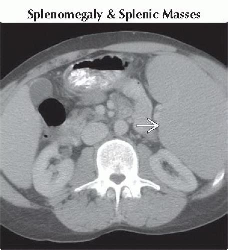 Da4 Db2 Left Upper Quadrant Mass Ffu1  Abdominal Key