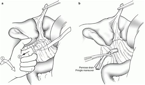 Liver And Extrahepatic Bile Ducts Plastic Surgery Key