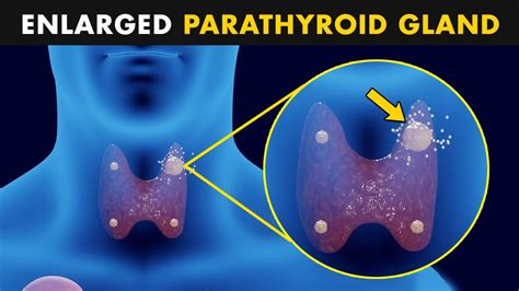 Hyperparathyroidism Symptoms Causes And Treatment Youtube