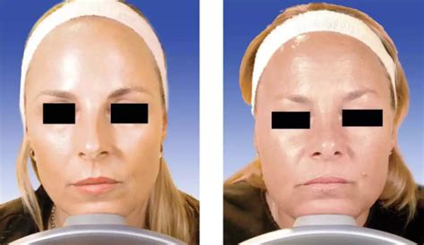 Identical Twins Share Astounding Results After One Used Botox For 20