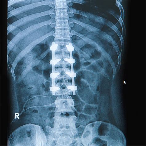 Nerve Root Irritation Treatment Physiotherapy Australia