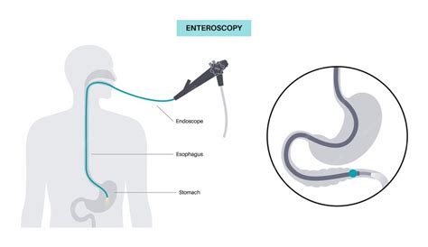 Premium Vector Balloon Assisted Enteroscopy Visualization Of The