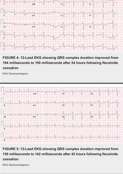 Figure 5 From A Rare Case Report Of Flecainide Induced Left Bundle Branch Block Lbbb And