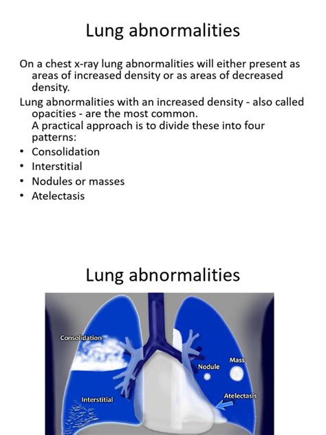 Lung Consolidation Pdf Lung Pneumonia
