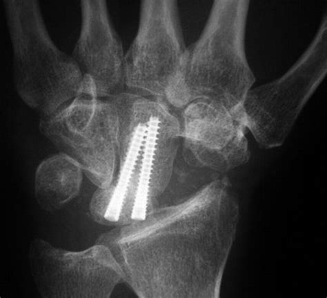 Clinical Outcomes Of Scaphoid And Triquetral Excision With Capitolunate