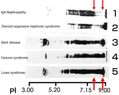 Figure 1 From Origin Of Proteinuria As Observed From Qualitative And