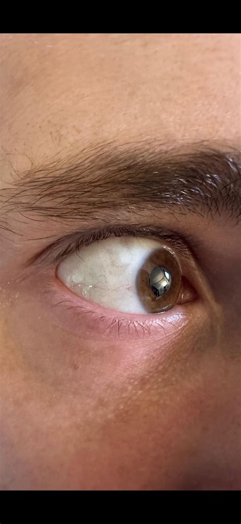 Major Pressure Behind Eyes Darkened Inflamed Whites Of Eyes R Diagnoseme