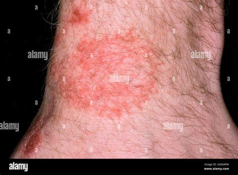 Contact Dermatitis Close Up Of A Rash On The Wrist Of A 22 Year Old