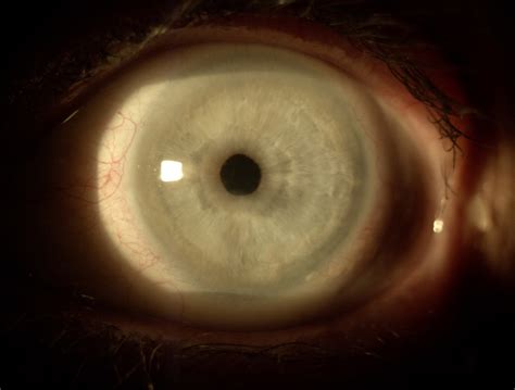 Corneal Scar Gallery Gulani Vision Institute