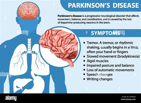 Nhs Parkinsons Disease Getting The Right Healthcare Wuttl