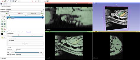 Problems With Segmentation Of Bone Muscle And Fat Support D Slicer Community