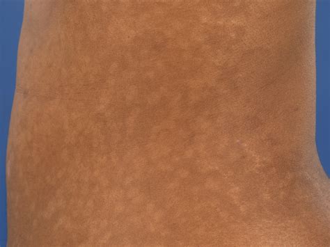 Pityriasis Versicolor Pityriasis Versicolor Images Dermnet Nz