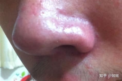 引起的酒糟鼻的因素解决酒糟鼻用这招 知乎
