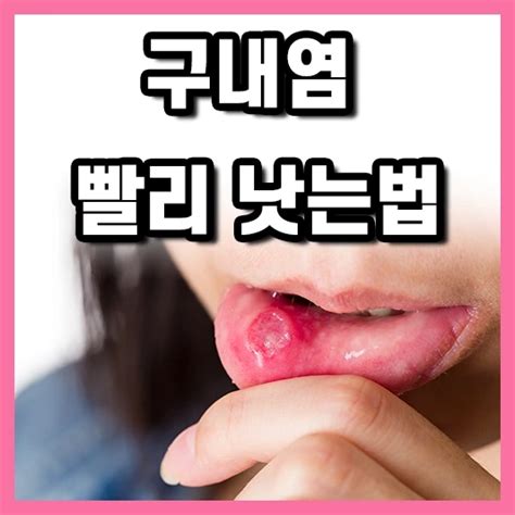 구내염 빨리 낫는법 쉽고 간단한 방법 총정리